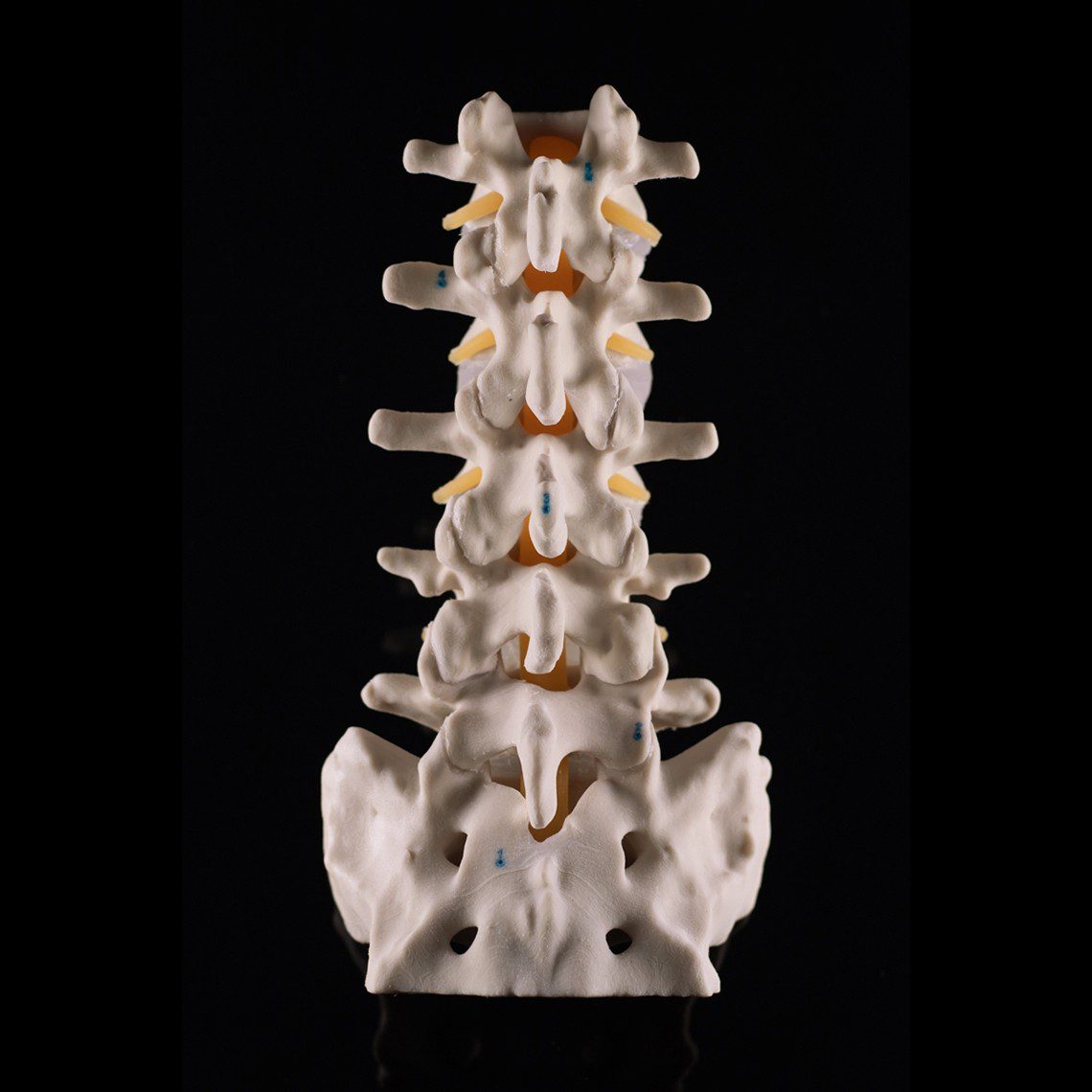 [SP-ee] PHACON Spine Patient "Otto" - lumbar spine with pelvis